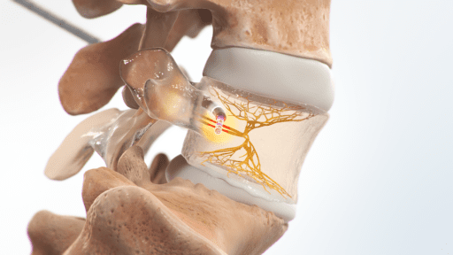 Find Long-Lasting Relief from Chronic Low Back Pain with the Intracept® Procedure