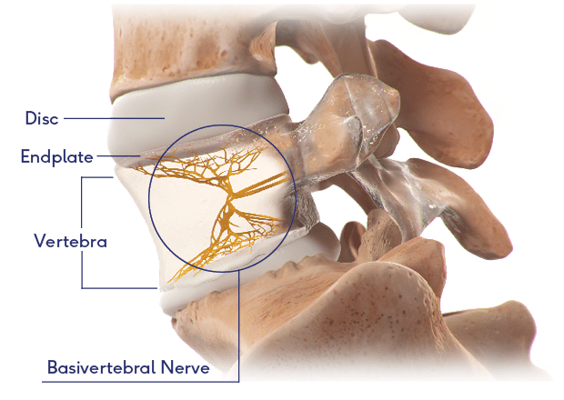 Intracept Procedure - Orthopedic Associates